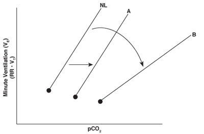 Sedation & Respiratory Depression – Department of Pediatrics – UW–Madison