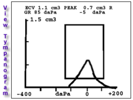 Tympanometry – Department of Pediatrics – UW–Madison