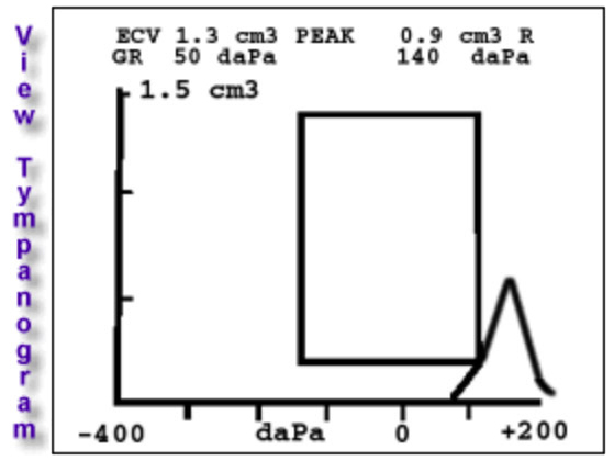 Tympanometry – Department of Pediatrics – UW–Madison
